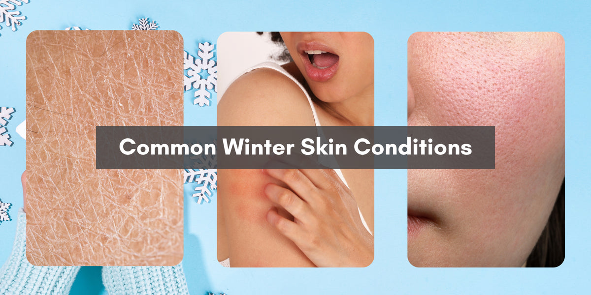 Unraveling Winter’s Skin Woes: Understanding Common Cold-Weather Skin ...